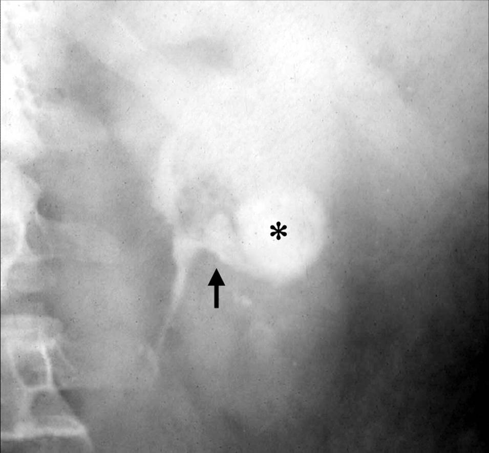 ABC Radiology Blog: The Golf Ball–on-Tee Sign