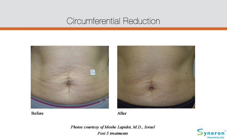 VelaCenter: Casos clinicos de VelaShape: Antes y Después.