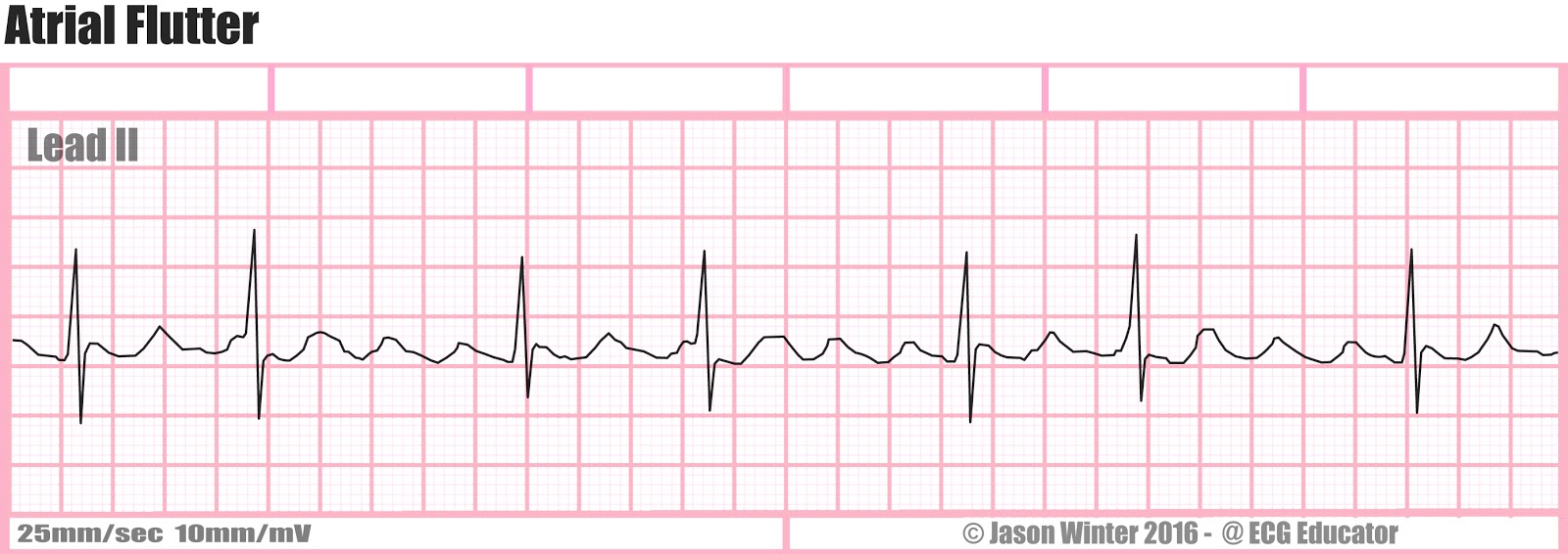 ECG Educator Blog : Six Second ECG Rhythm Strips