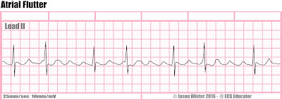 ECG Educator Blog : Six Second ECG Rhythm Strips