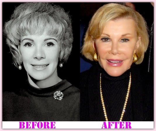 plasticbeforeafter: Joan Rivers Plastic Surgery – Is She Addicted To It