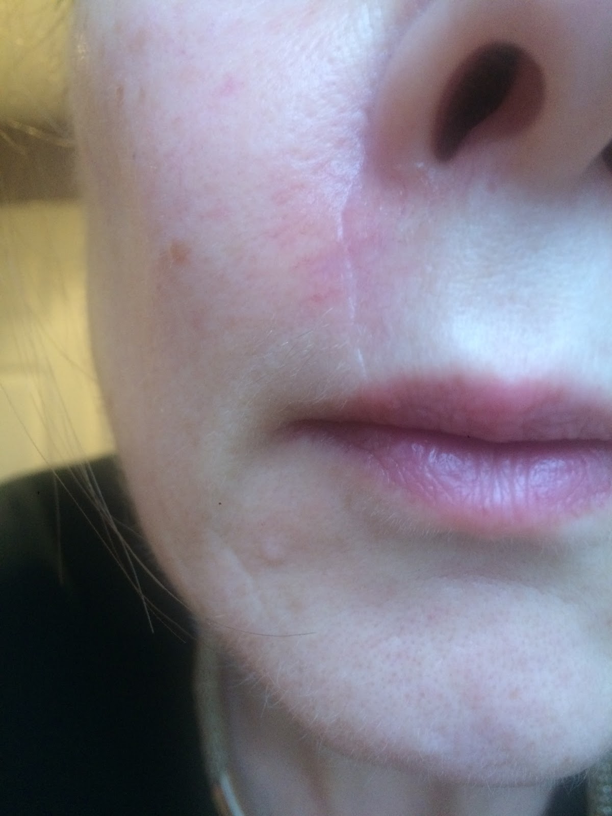 BraveFace . Diary of a facial basal cell carcinoma ( bcc): 2017