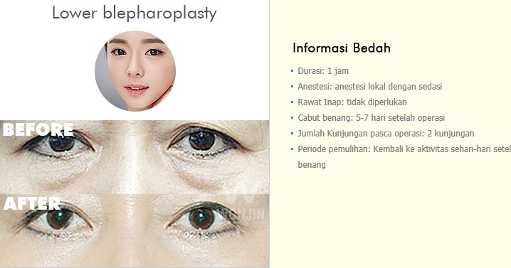 Apa itu operasi bawah mata?