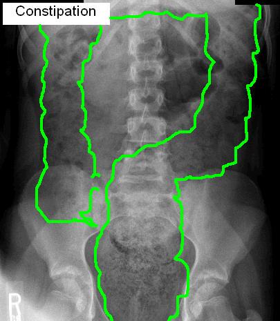 Bluebonnet Natural Healing Therapy.com: Diverticulosis and ...