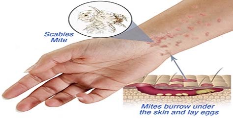 Scabies Symptoms, Treatment, and Prevention • TheGep Diseases