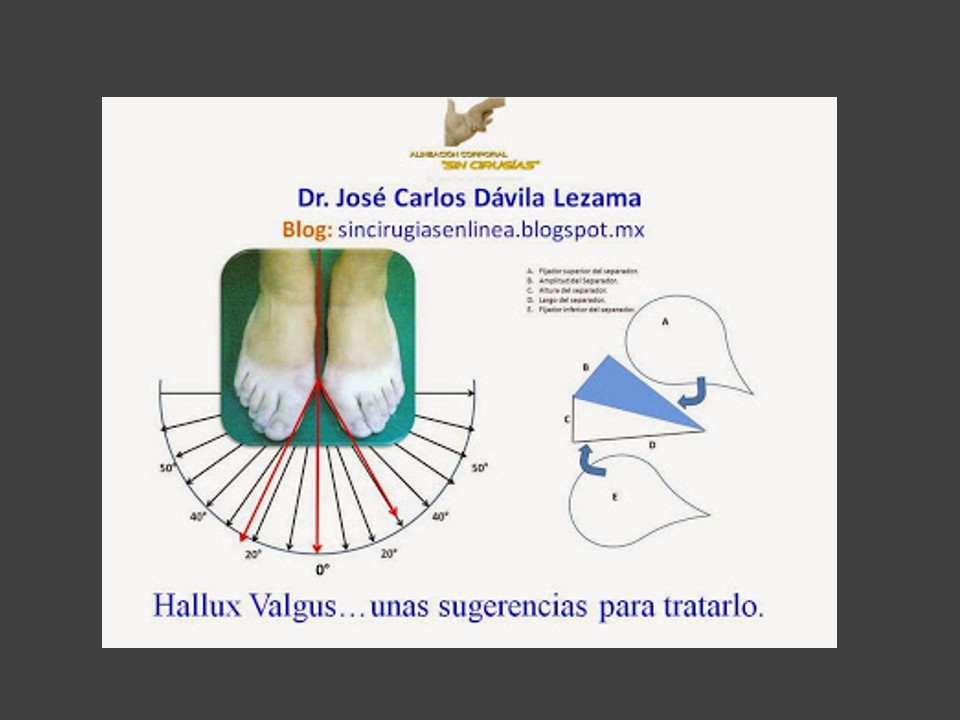SIN CIRUGÍAS en LÍNEA: JUANTES o HALLUX VALGUS