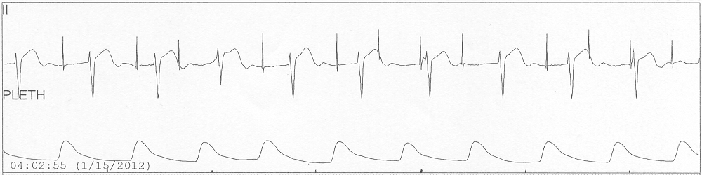 Pedi cardiology: Pacemaker - Non-capture