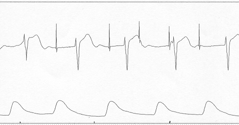 Pedi cardiology: Pacemaker - Non-capture