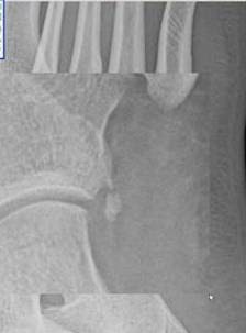 Os Peroneum Fracture-Plain Film - Sumer's Radiology Blog