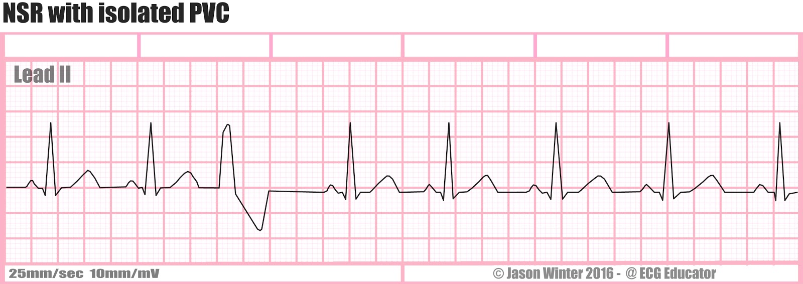 ECG Educator Blog : Six Second ECG Rhythm Strips