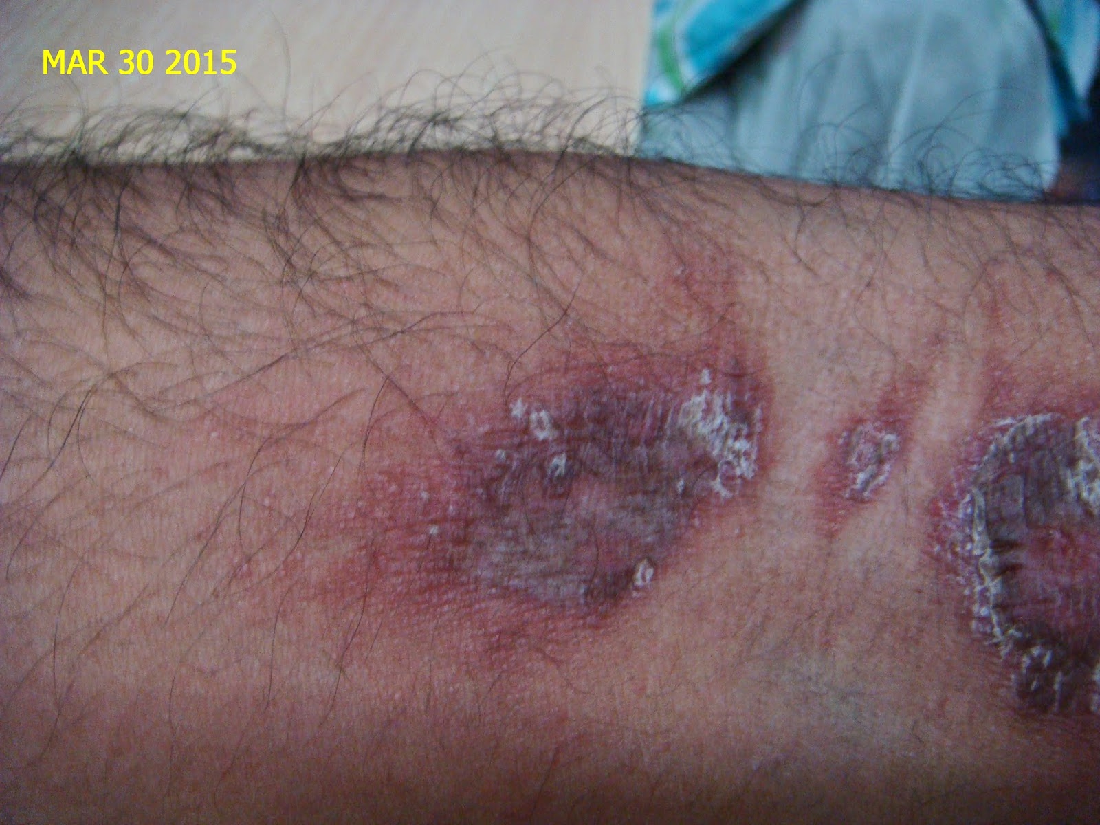 CONSULT HOMEOPATHY: A Case of Acute Dermatitis