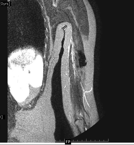 Retained Broken Injection Needle-MRI - Sumer's Radiology Blog