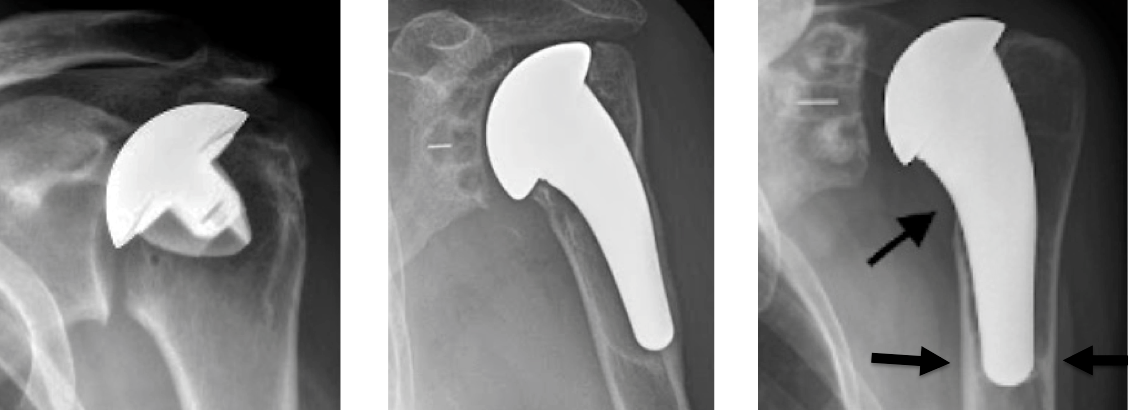 Shoulder Arthritis / Rotator Cuff Tears / Shoulder Pain : Shoulder ...