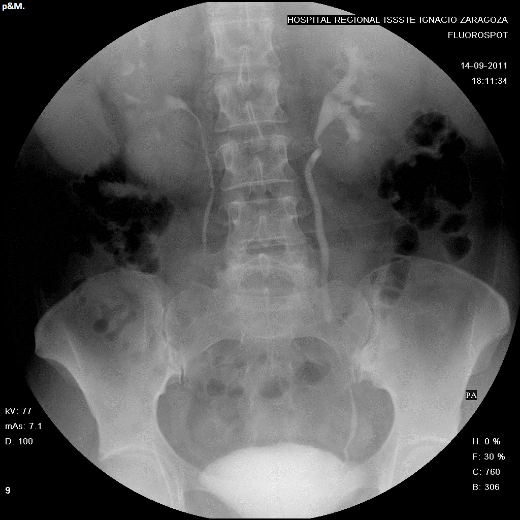 RADIOLOGIA e IMAGEN CETIS 76: UROGRAFIA EXCRETORA
