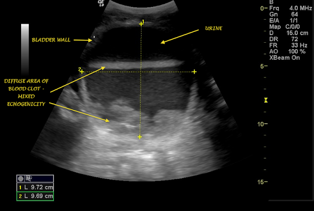 Bladder Scanning in Hematuria ~ Ultrasound Cases Info