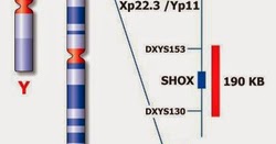 DEFICIÊNCIA COM BAIXA ESTATURA CONTENDO HOMEOBOX GENE (SHOX) EM CRIANÇA ...