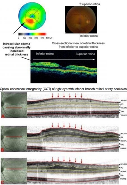 Branch Retinal Artery Occlusion - CatatanDokter