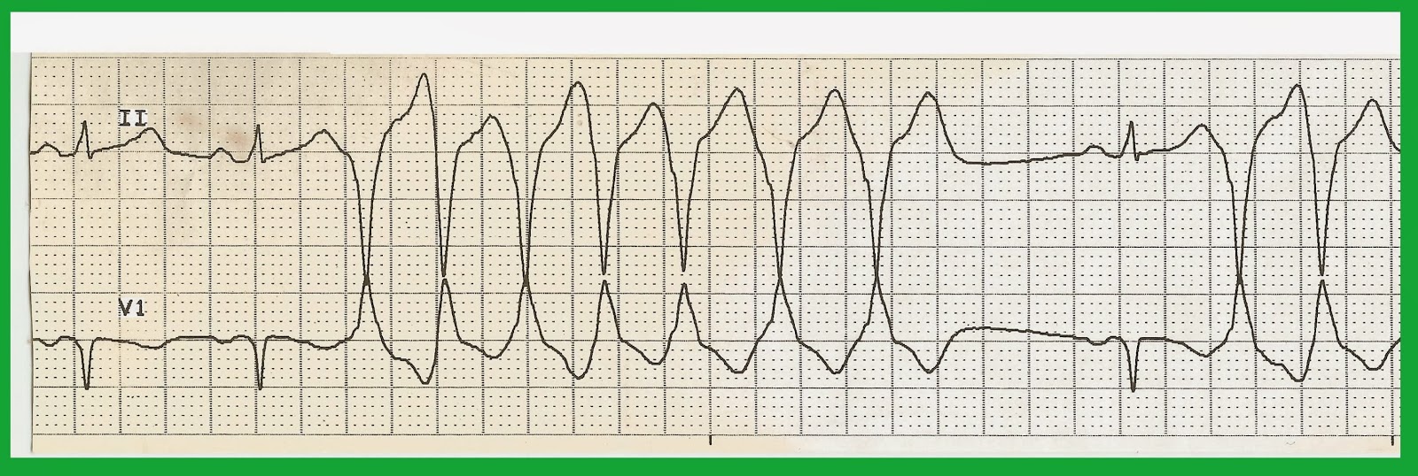 EKG Rhythm Strip Quiz 187
