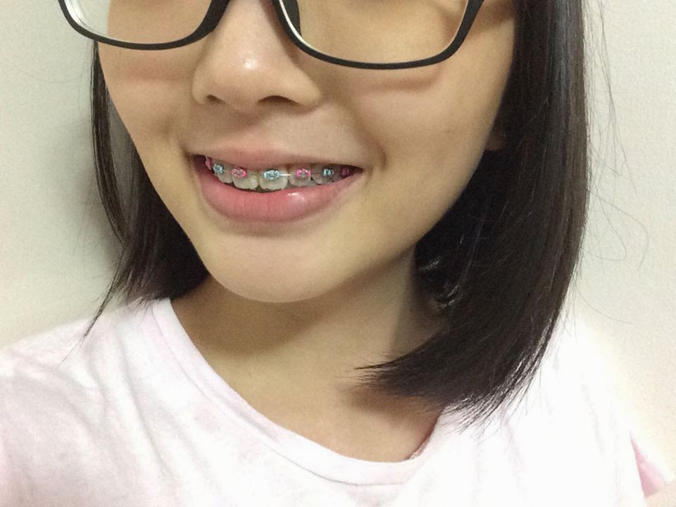 ♛Geraldine Yan♛: MY "BRACES" JOURNEY PART 3