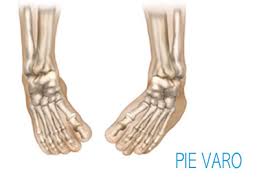 GUSTAVO PAVKA. PODÓLOGO........: ALTERACIONES OSTEOARTICULARES: