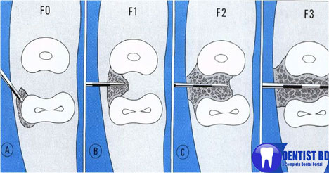 Furcation involvement classification | DENTIST BD BLOG