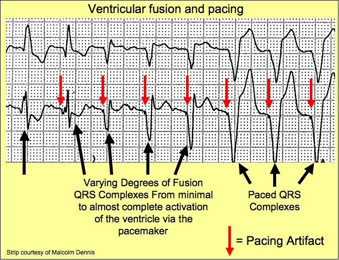 Cardiac Nurse: Teaching As I Learn: DDD pacing with psuedo fusion
