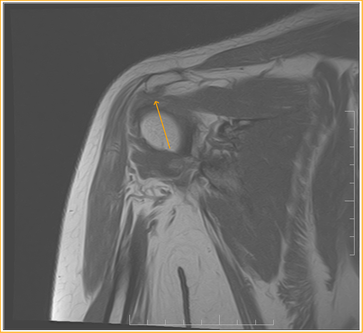 Rotator Cuff Impingement Syndrome - Sumer's Radiology Blog