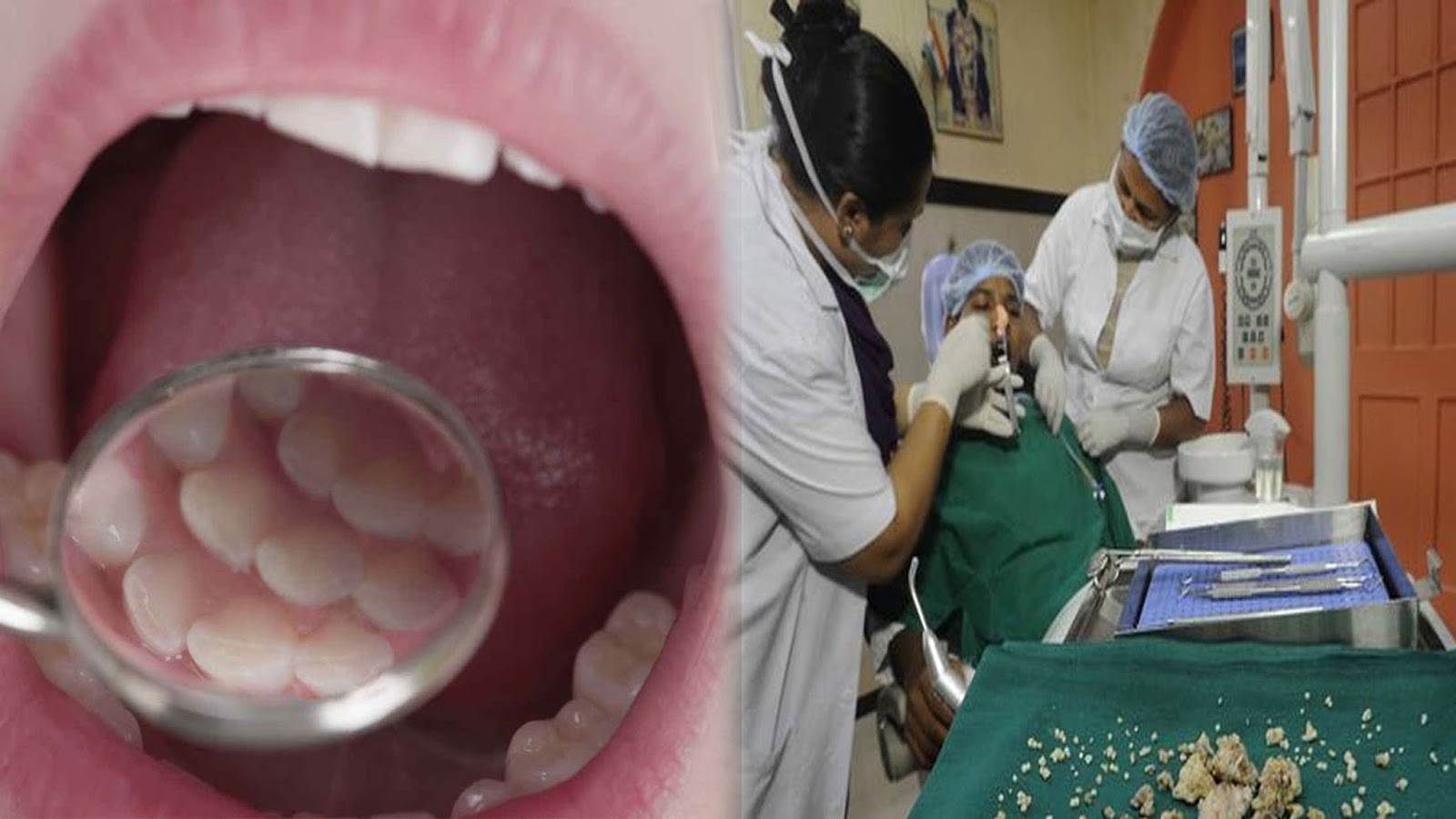 17 Year Old Boy Underwent a Seven-Hour Operation to Remove his 232 ...