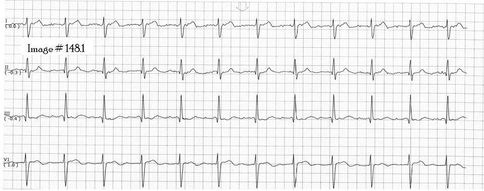 ECG Rhythms: The Lewis Lead: A lead placement to see oscillations