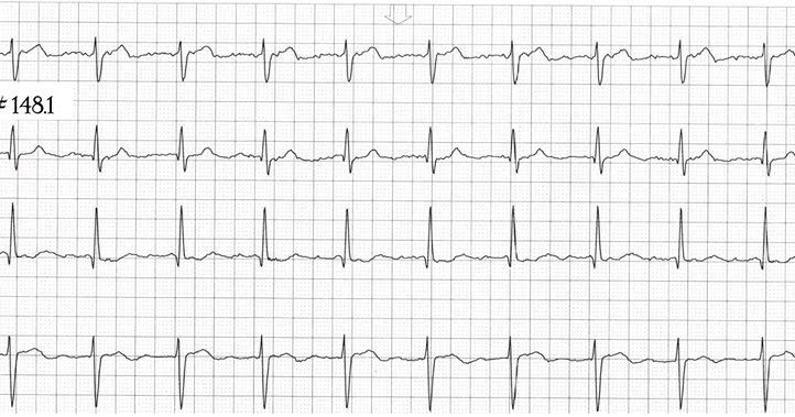 ECG Rhythms: The Lewis Lead: A lead placement to see oscillations