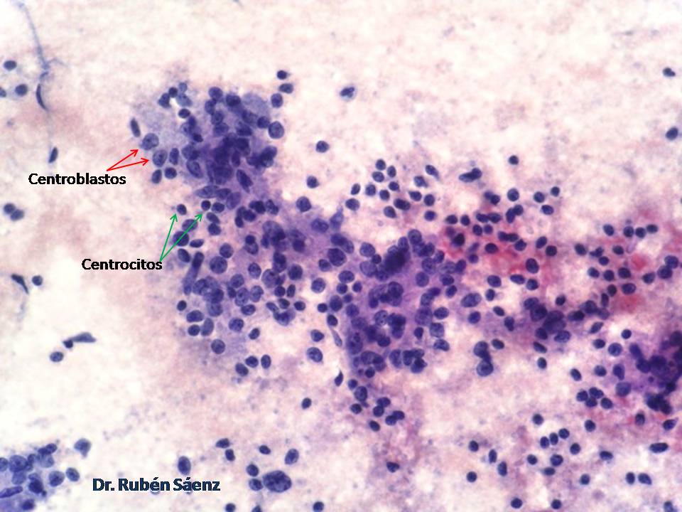 THE PERUVIAN CYTOPATHOLOGY CORNER: GANGLIO LINFÁTICO: CENTROS GERMINALES