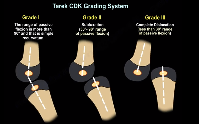 Dr. Nabil Ebraheim's Blogspot: Congenital Dislocation of the Knee