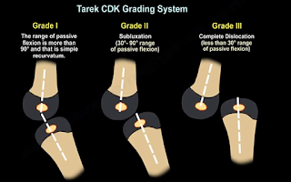 Dr. Nabil Ebraheim's Blogspot: Congenital Dislocation of the Knee