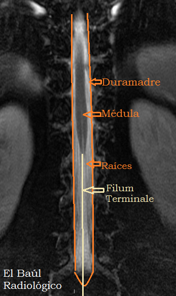 El Baúl Radiológico: LIPOMAS DEL "FILUM TERMINALE": HALLAZGOS EN TC y ...