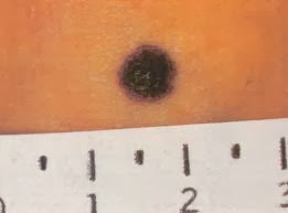 Dermatocare: Birthmarks- all of them are not black!!!