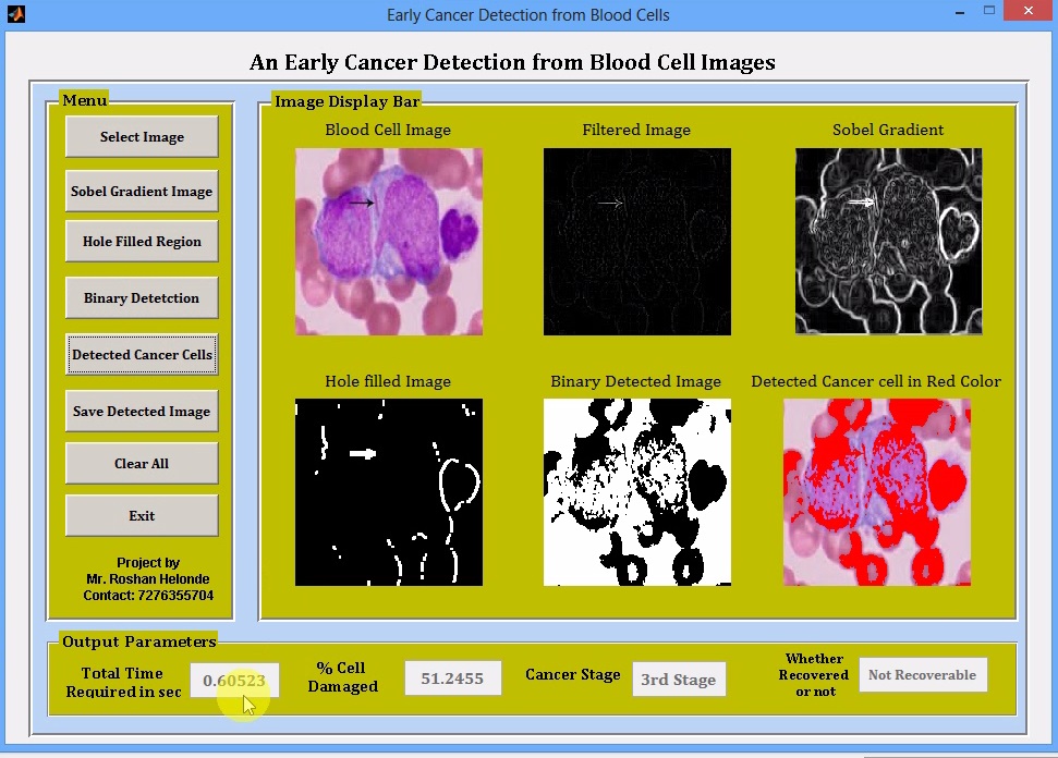 Blood Cancer (Leukemia) Detection Using Image Processing Matlab Project with Source code ...