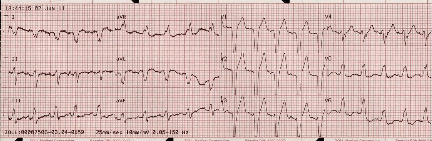 Dr. Smith's ECG Blog: Chest pain and LBBB. LBBB resolves and there is ...