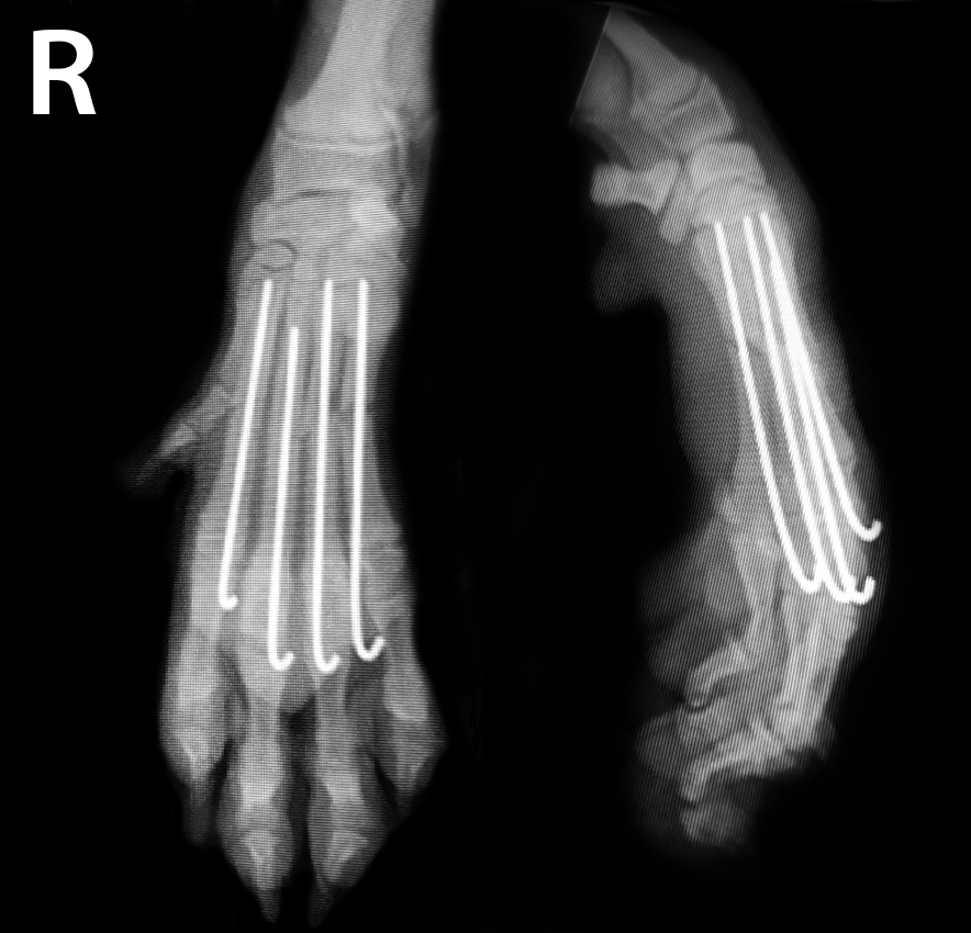 ARTROVET: Fractura de metacarpos