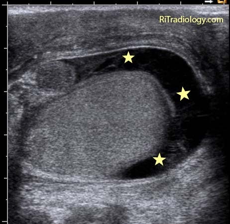 RiT radiology: Scrotal Pyocele