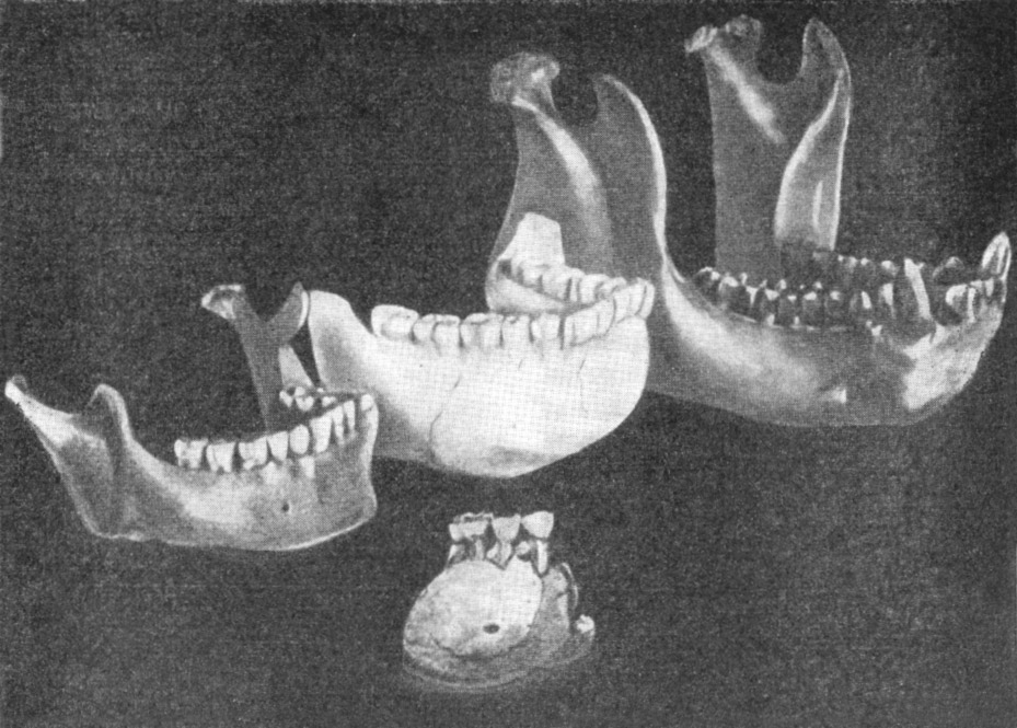 EL GIGANTE MEGANTHROPUS. | Los origenes del hombre