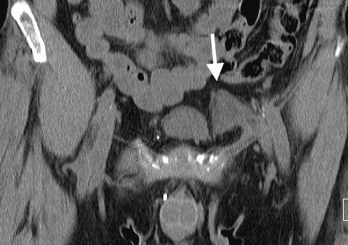 Roentgen Ray Reader: Mimicker: Inguinal Mesh Plug