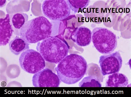Lab Atlas: Acute Myeloid Leukemia