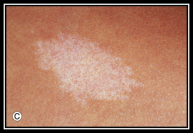 Mas allá de la epidermis!!!! : Proceso