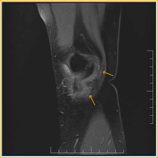 Posteromedial Corner Injury-MRI - Sumer's Radiology Blog