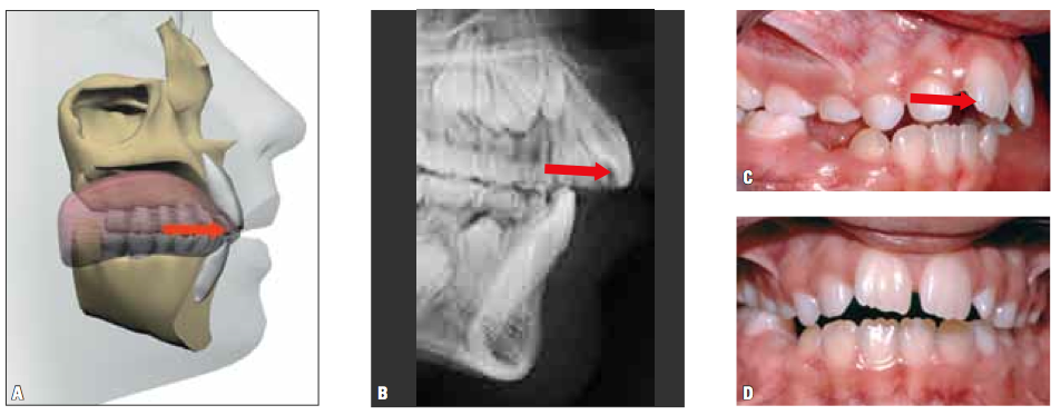 Orthodontic Corner: Anterior open bite and tongue positions, DPJO