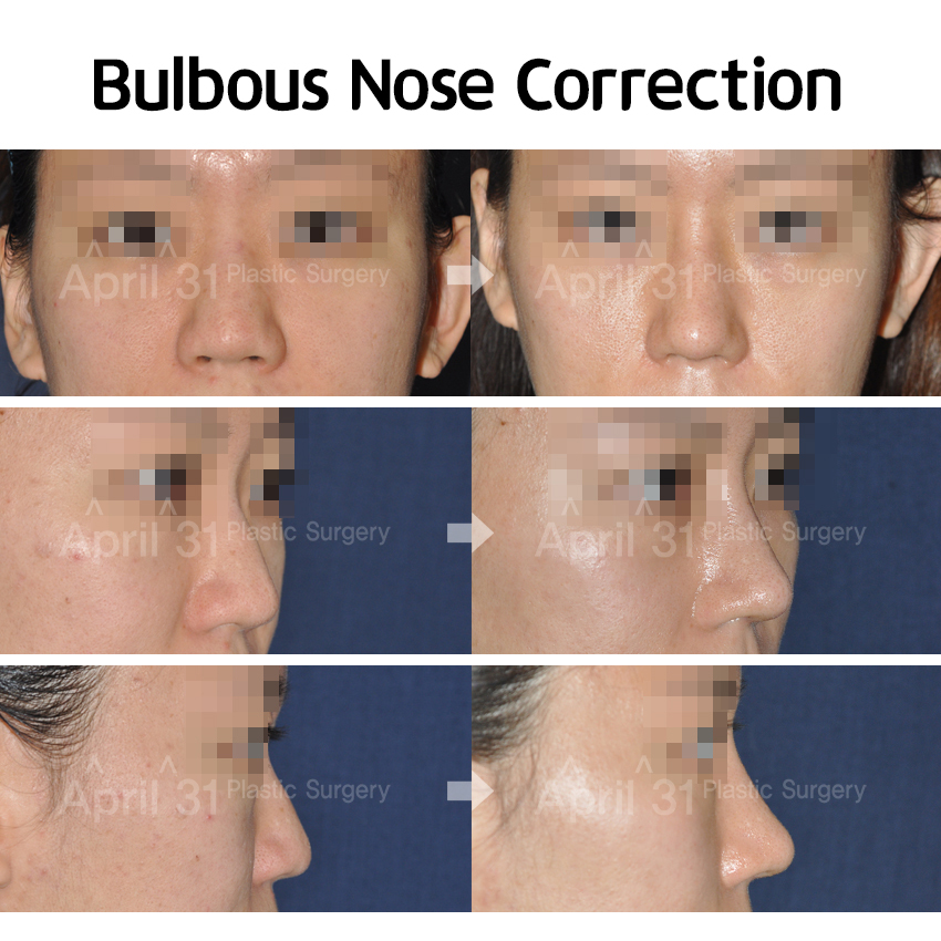 April31 Plastic Surgery Clinic: Bulbous Nose Correction