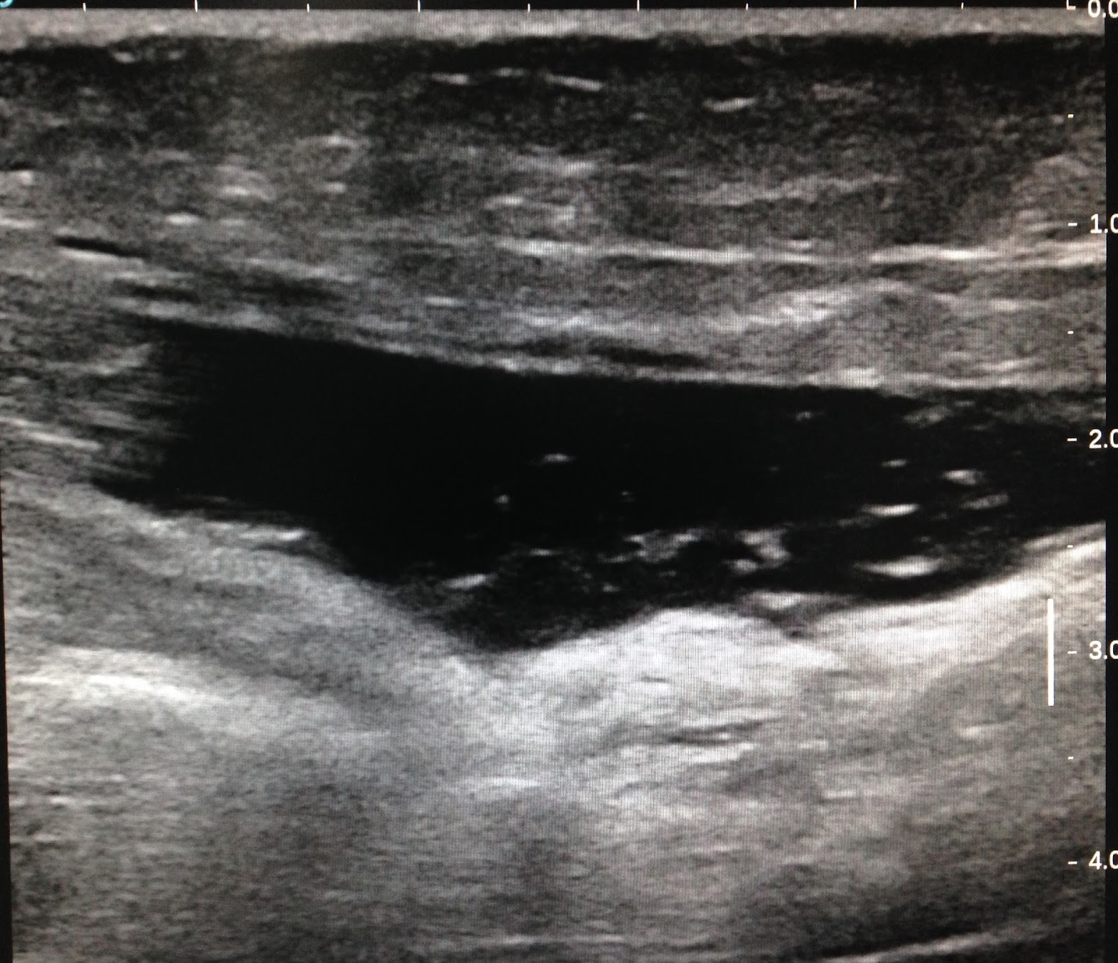 VIETNAMESE MEDIC ULTRASOUND: CASE 456 : LEG GAS GANGRENE, Dr PHAN THANH ...