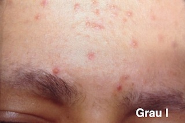 Acne - Conheça cada tipo e em cada fase da vida e seu tratamento ...