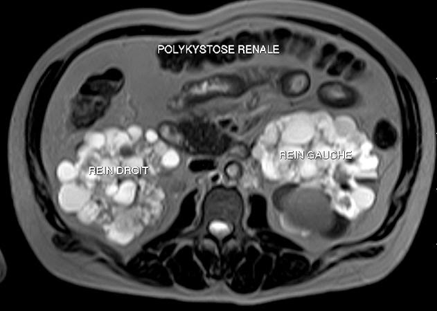 La polykystose rénale | Récap' IDE