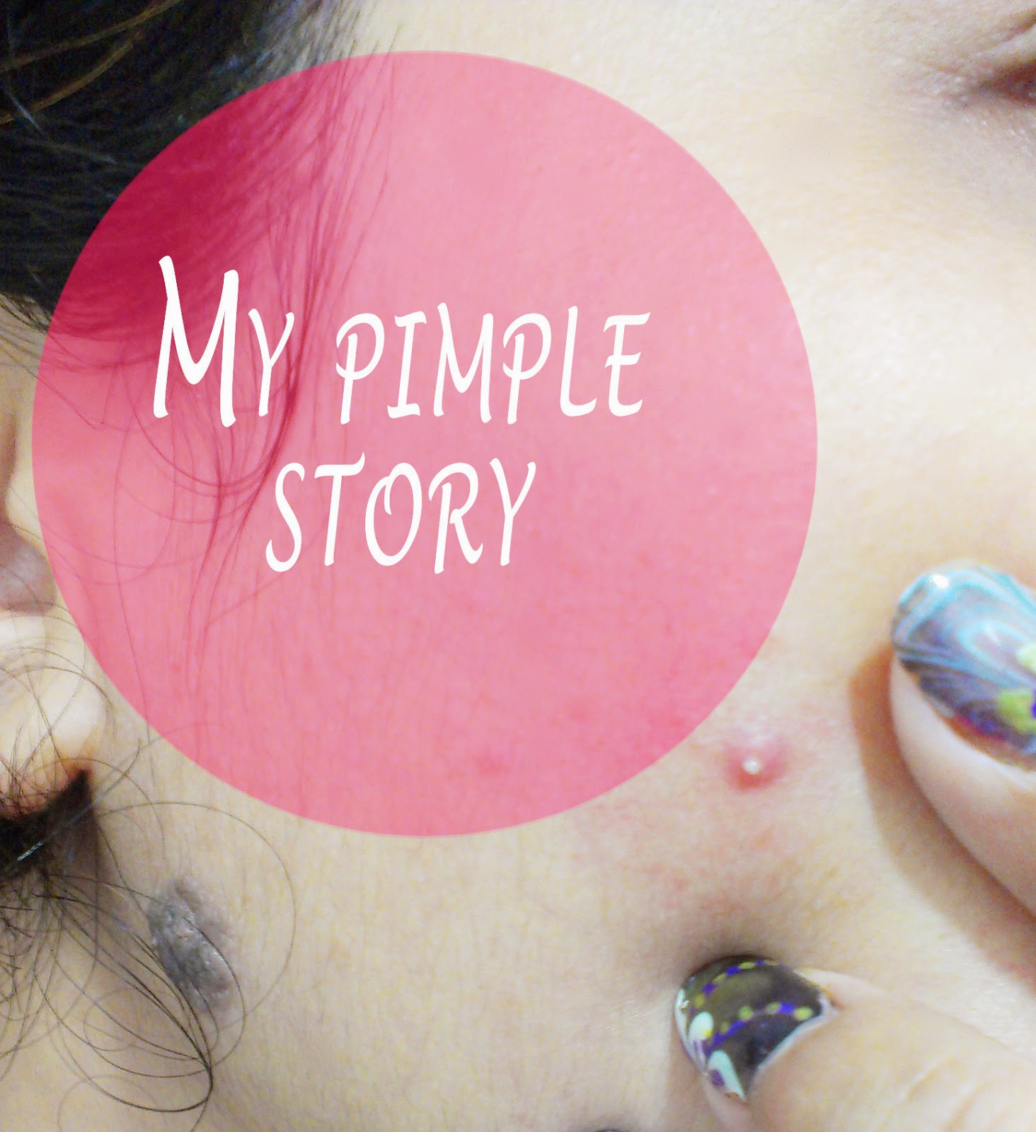 A Pimple Makes My Life Unpleasant - Beauty and Lifestyle Mantra - India ...